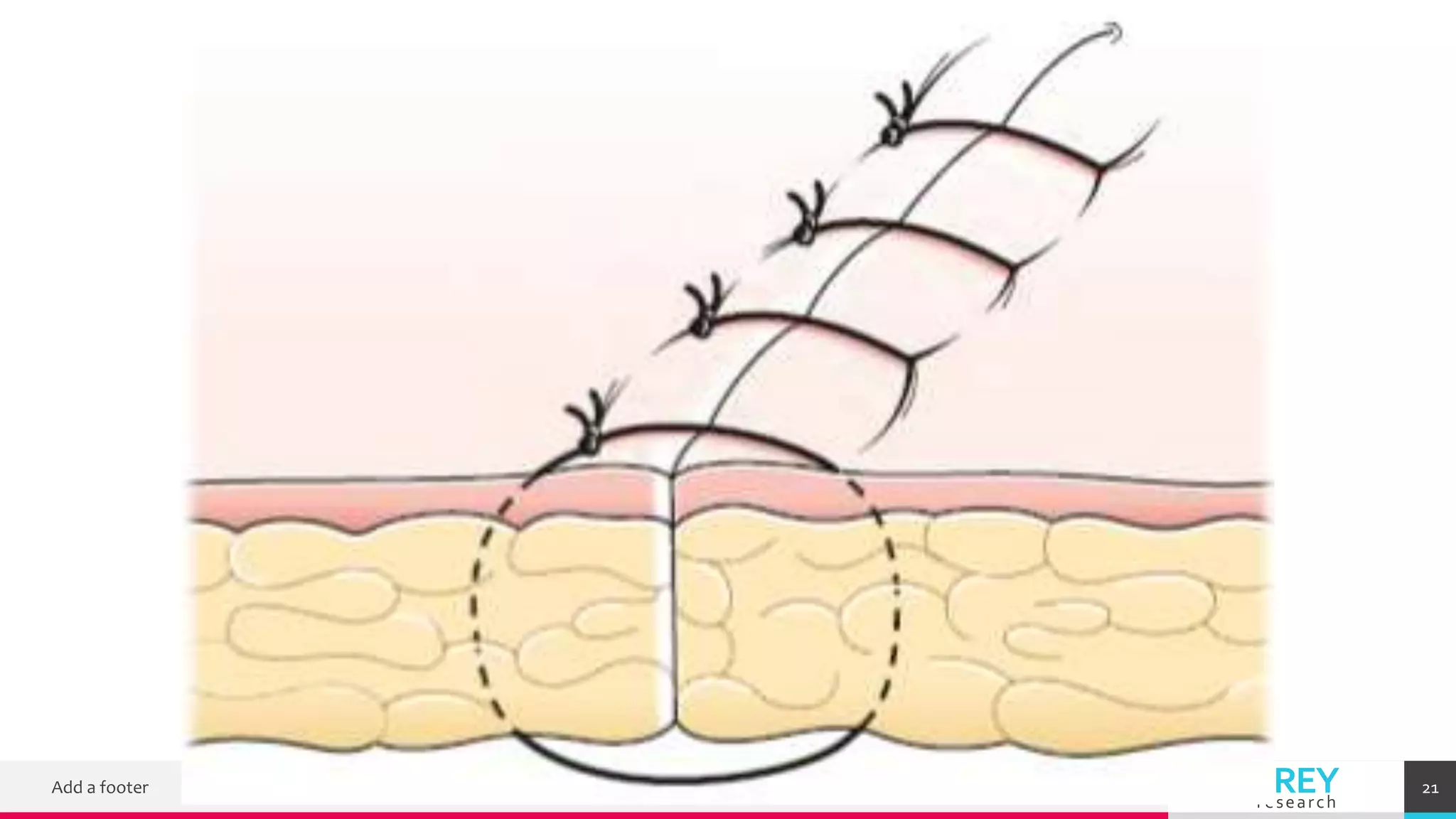 Suturing and Wound Closure | PPTX