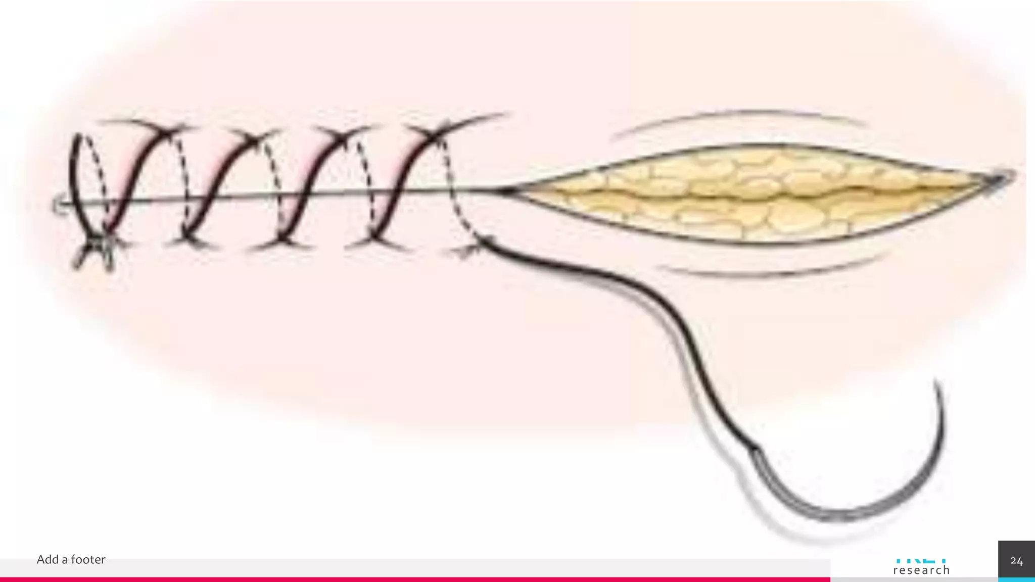 Suturing and Wound Closure | PPTX | First Aid | Injuries