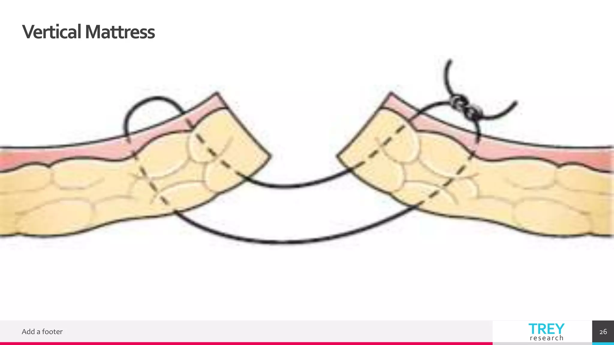 Suturing and Wound Closure | PPTX