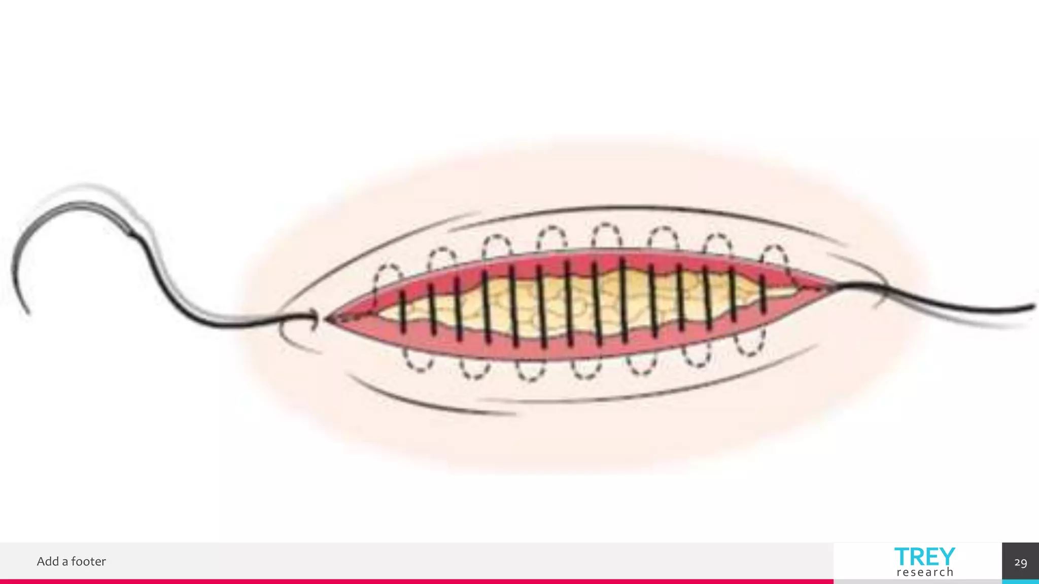 Suturing and Wound Closure | PPTX