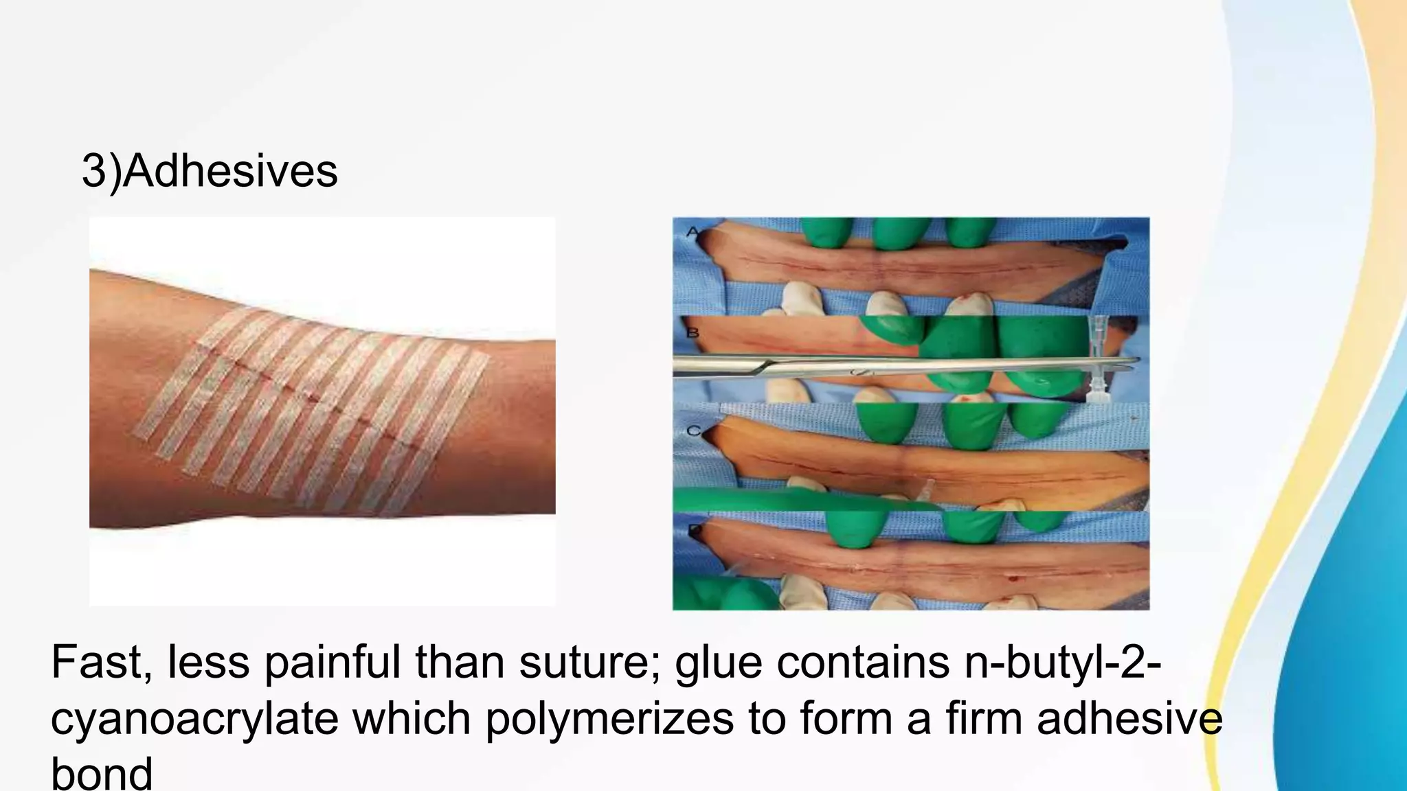 WOUND CLOSURE AND COMPLICATION | PPTX