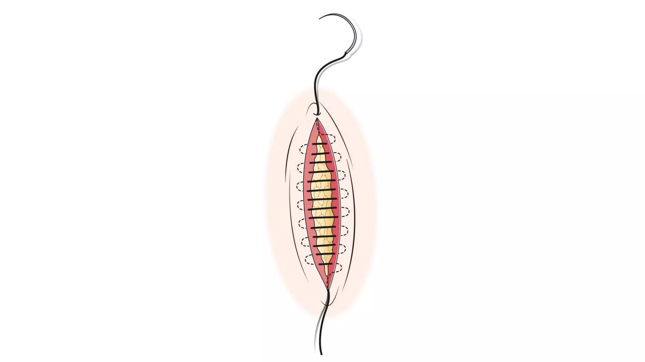 Wound closure, suture material, technique and alternative to suture ...