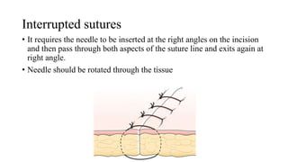 Wound closure, suture material, technique and alternative to suture | PPTX