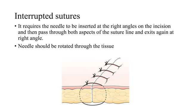 Wound closure, suture material, technique and alternative to suture ...