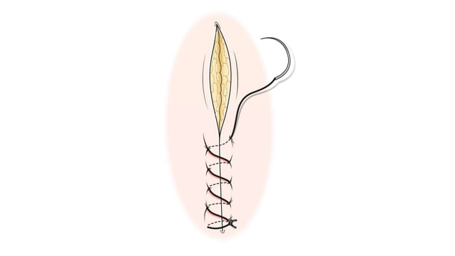 Wound closure, suture material, technique and alternative to suture ...