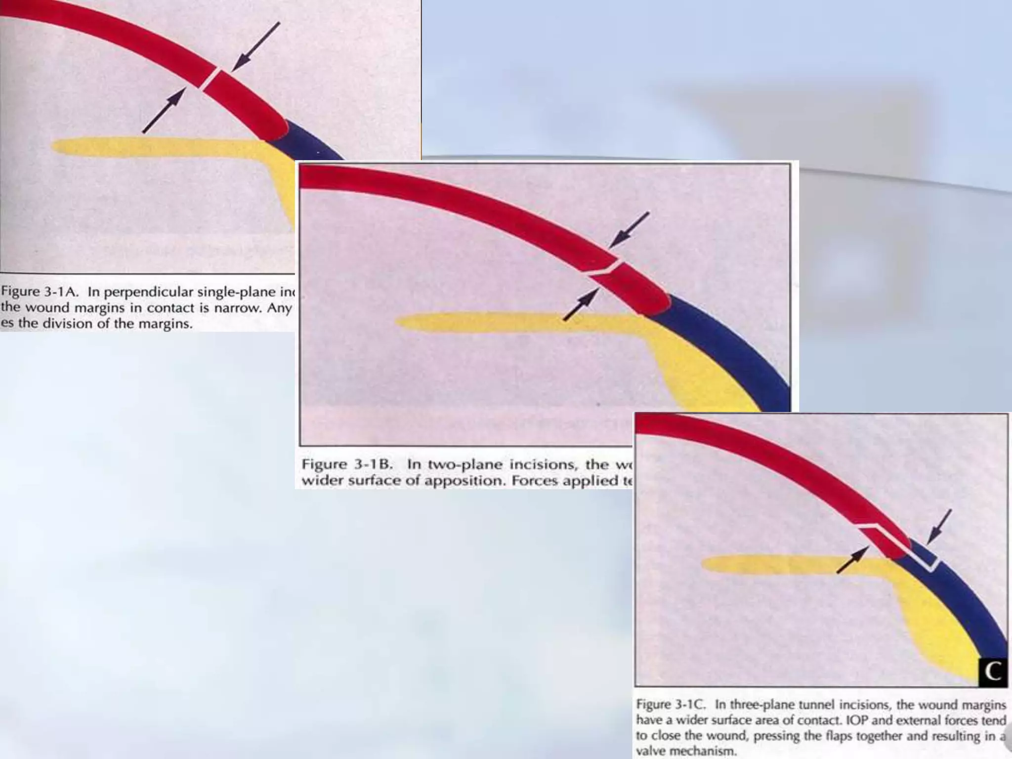 Wound construction For Cataract Surgery | PPTX