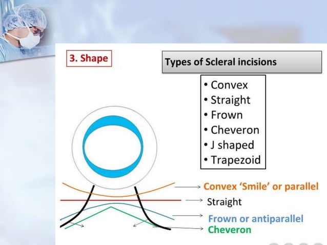 Wound construction For Cataract Surgery | PPTX