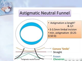 Wound construction For Cataract Surgery | PPTX