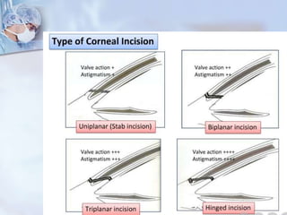 Wound construction For Cataract Surgery | PPTX