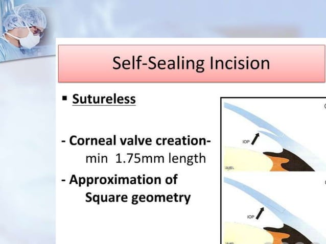 Wound construction For Cataract Surgery | PPTX