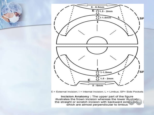 Wound construction For Cataract Surgery | PPTX