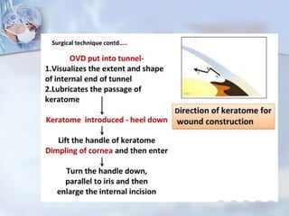 Wound construction For Cataract Surgery | PPTX