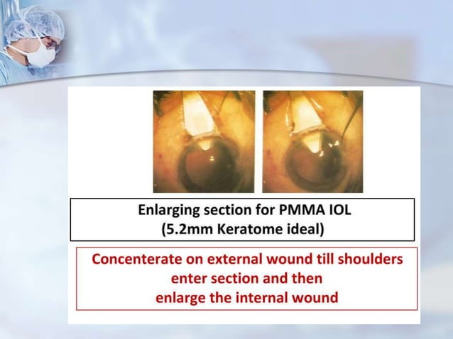 Wound construction For Cataract Surgery | PPTX