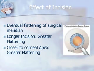 Wound construction For Cataract Surgery | PPTX