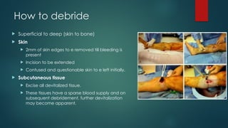 WOUND DEBRIDEMENT in orthopaedics by Dr. Deepak | PPTX | First Aid ...