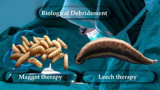 wound debriderment.pptx