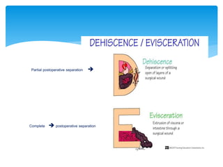 WOUND DEHISCENCE | PPT