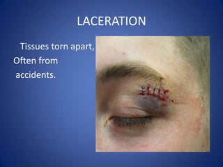 Wound dressing | PPTX