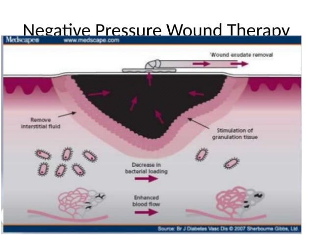 wound dressing with technique to solve them | PPTX