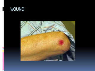 WOUND DRESSING STEPS AND TYPE WITH NURSES ROLE.ppt