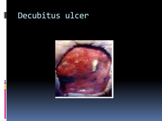 WOUND DRESSING STEPS AND TYPE WITH NURSES ROLE.ppt | First Aid | Injuries