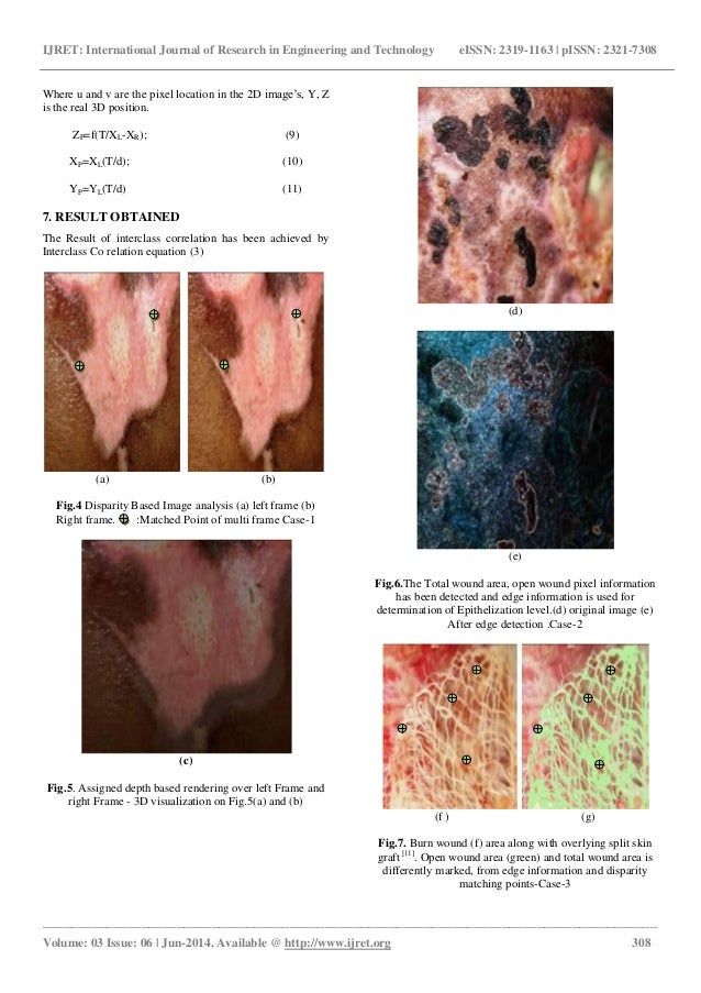 Wound epithelization model by 3 d imaging