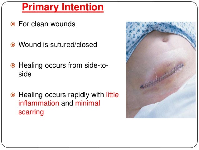 Wound for c i