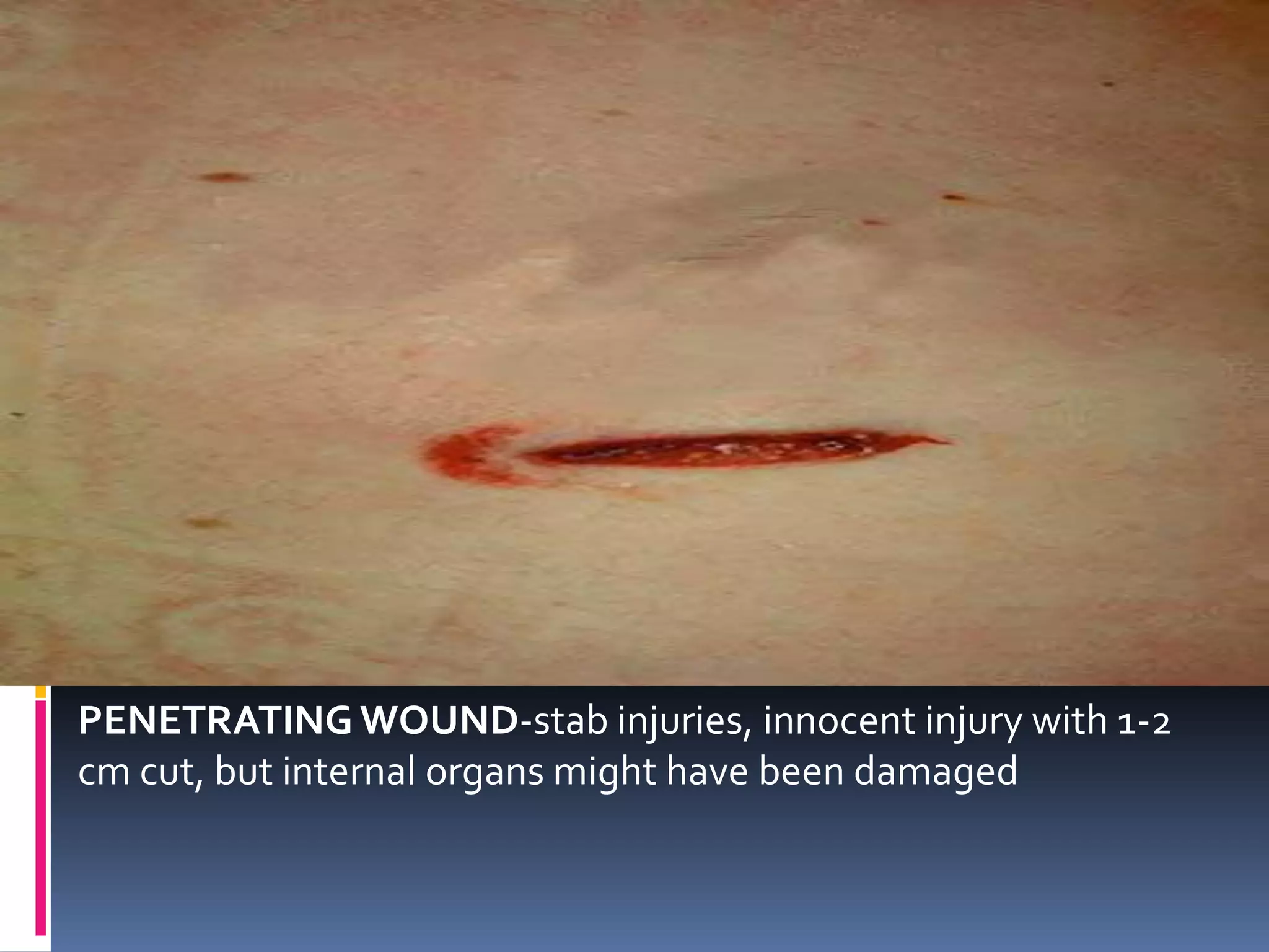 Wound healing | PPTX