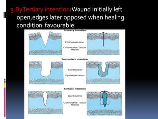 Wound Healing Primary Intention