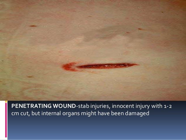 Wound healing