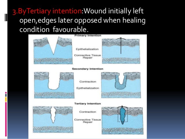 Wound healing