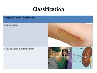 Wound healing | PPTX