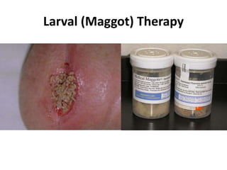 Maggot Therapy For Wounds