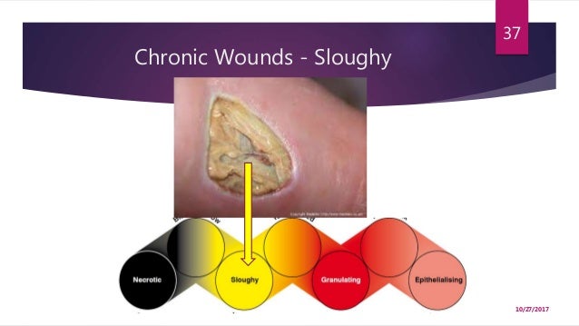 Wound healing
