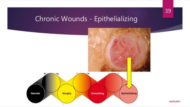 Wound healing
