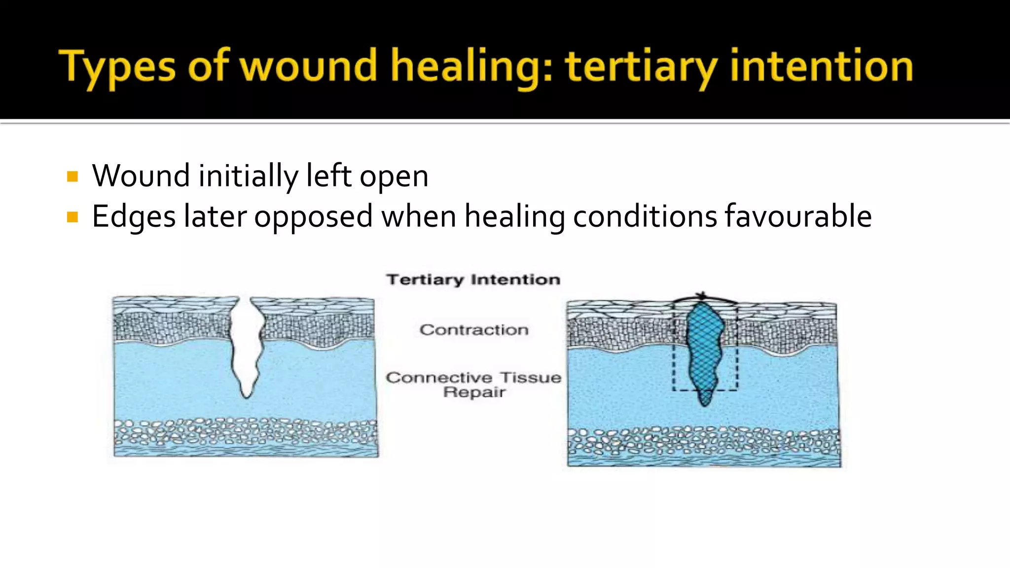 Wound healing | PPTX