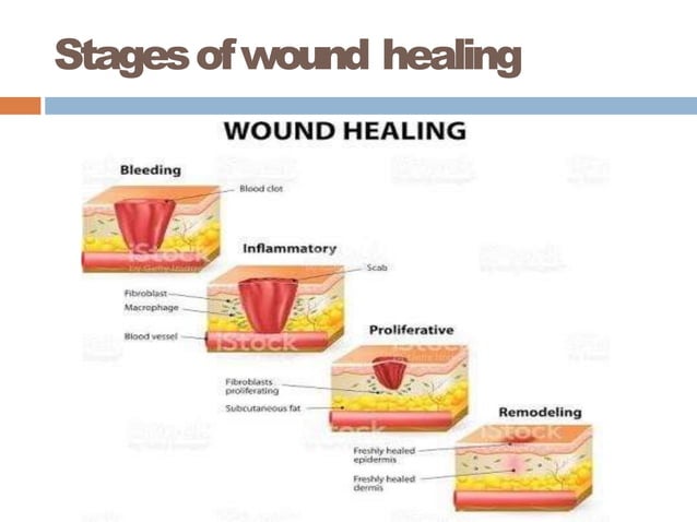 Wound healing | PPT