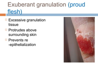 Wound healing | PPT