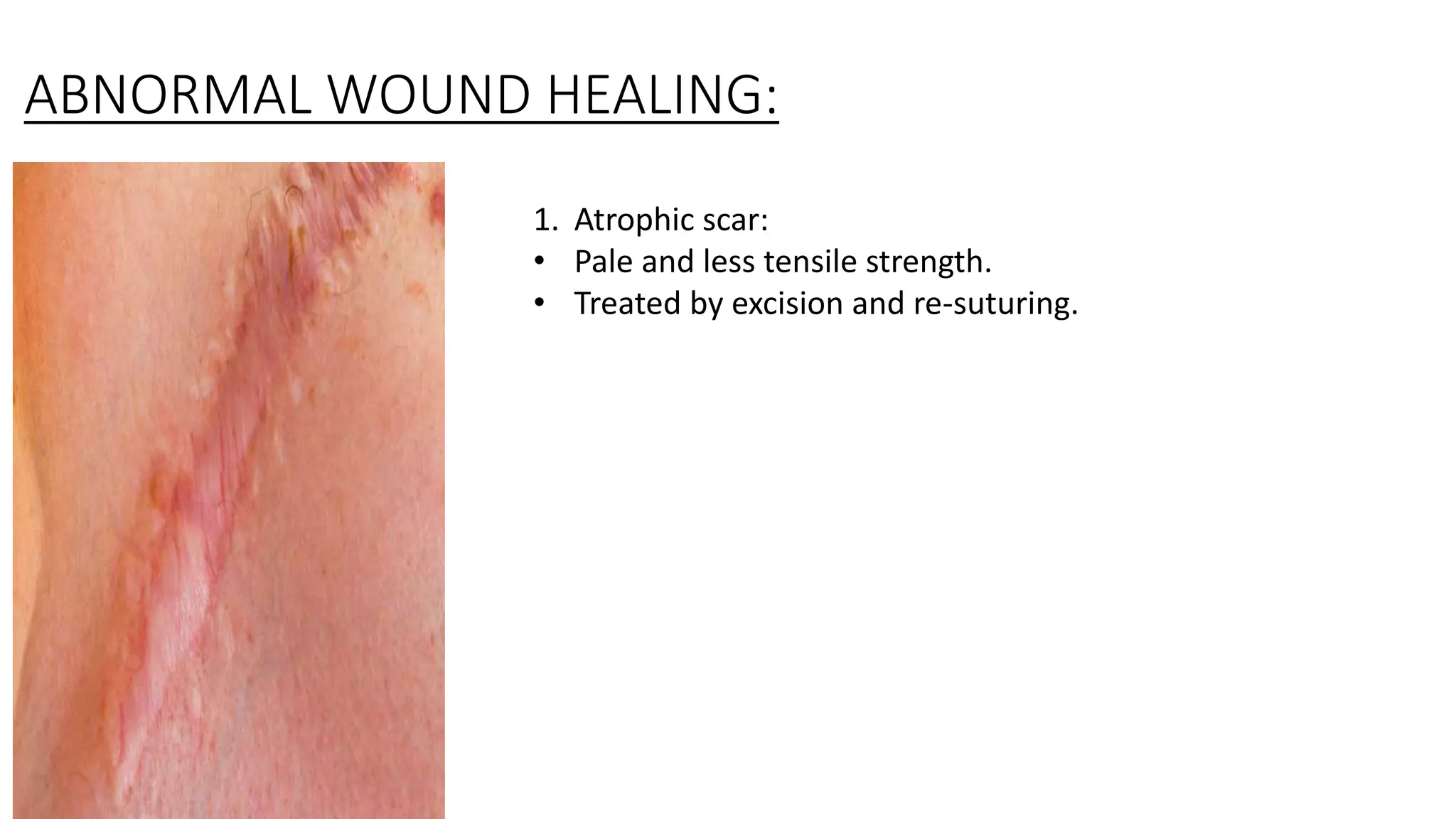 Wound healing | PPTX