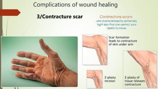 Wound healing | PPT