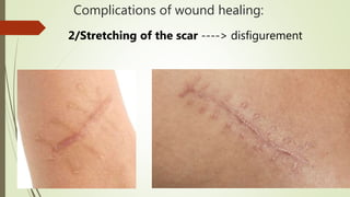 Wound healing | PPT