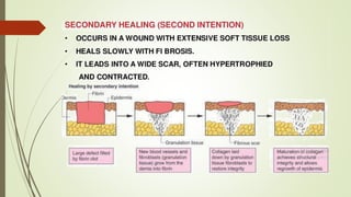 Wound healing | PPT