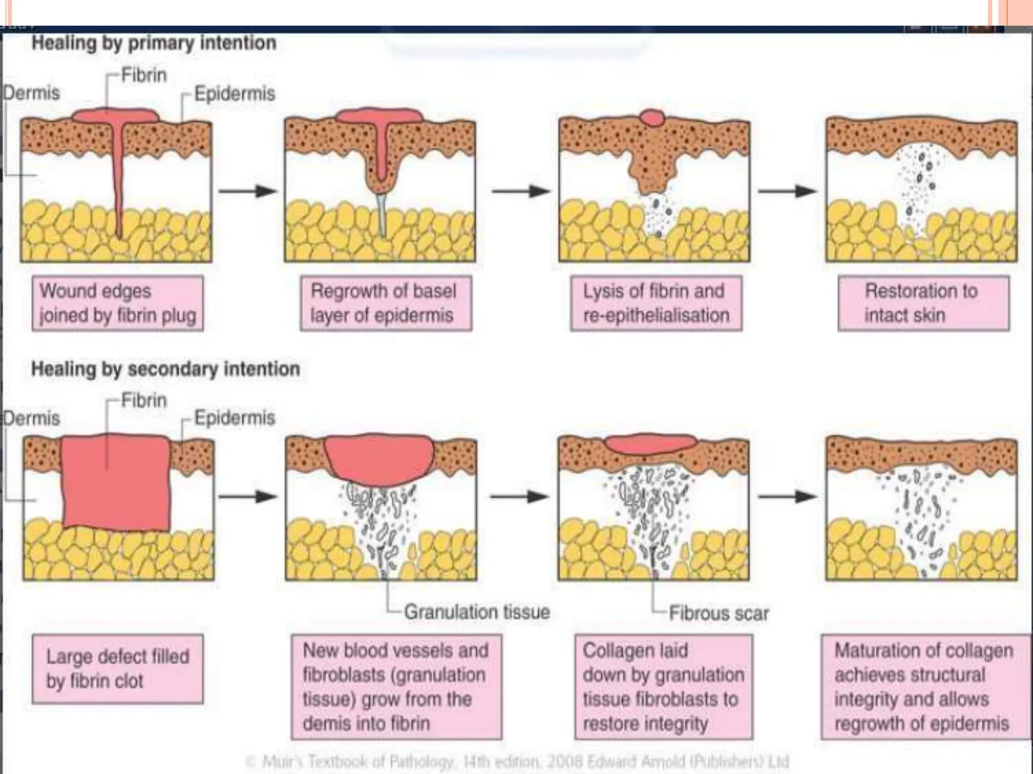 woundhealing bacteria inflammation and repair | PPT