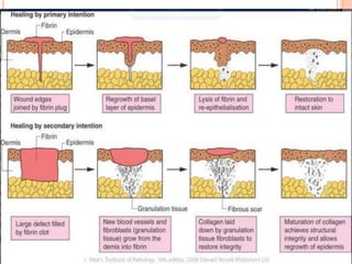 woundhealing bacteria inflammation and repair | PDF