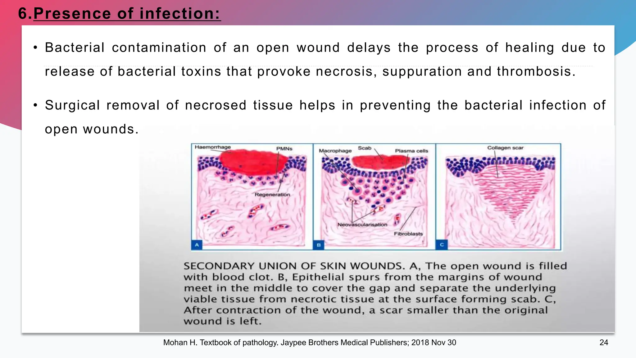 WOUND HEALING. wound healing in general, wound healing in dentistry. | PPTX