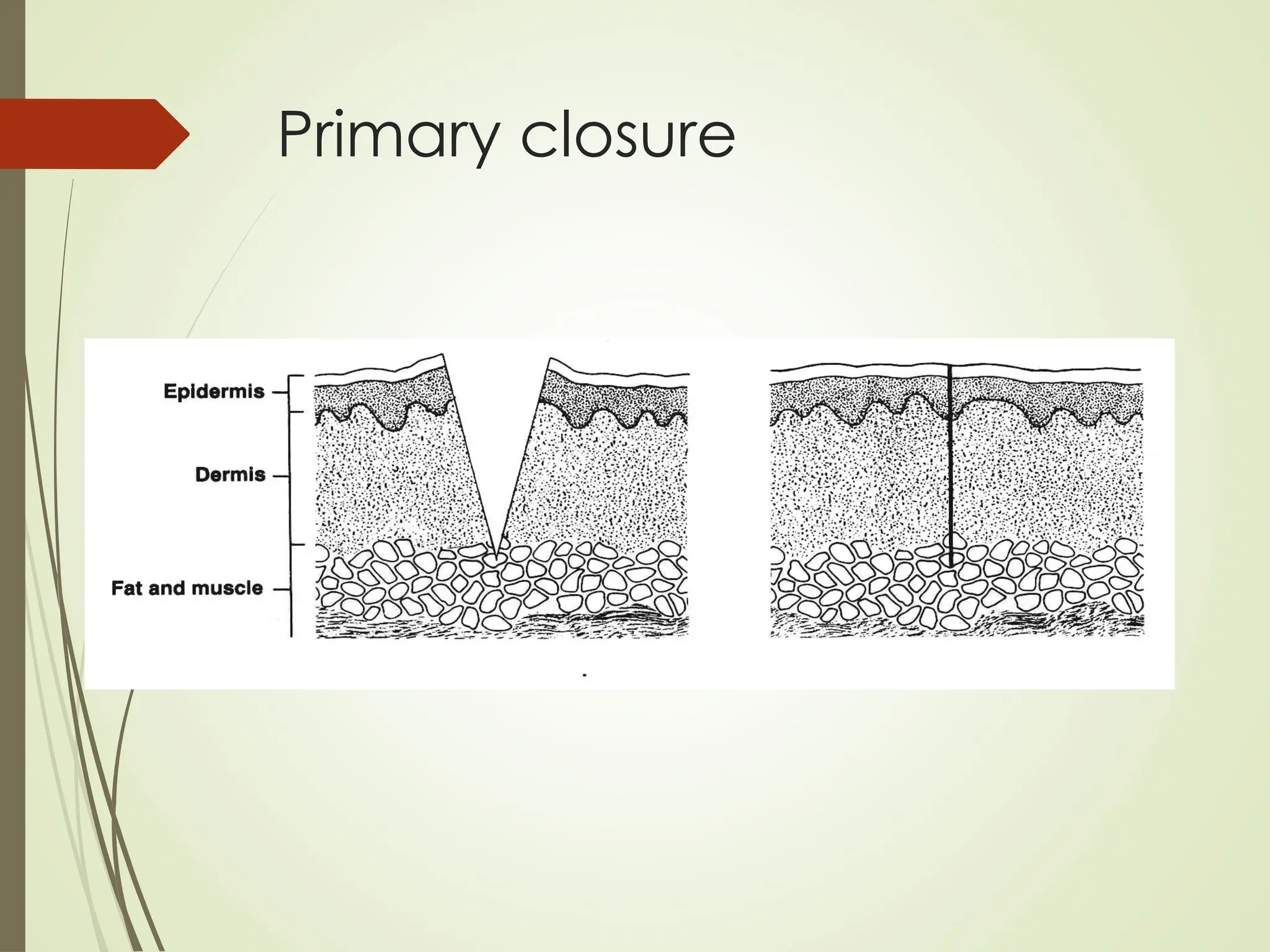 Wound Healing - Phases, Types of wound closure | PPTX
