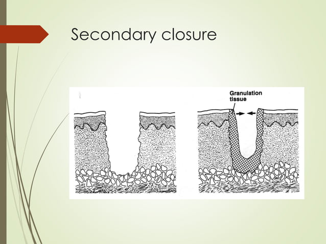 Wound Healing - Phases, Types of wound closure | PPTX