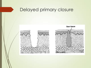 Wound Healing - Phases, Types of wound closure | PPTX