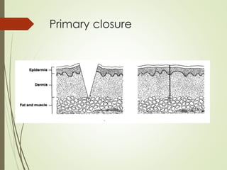 Wound Healing - Phases, Types of wound closure | PPTX