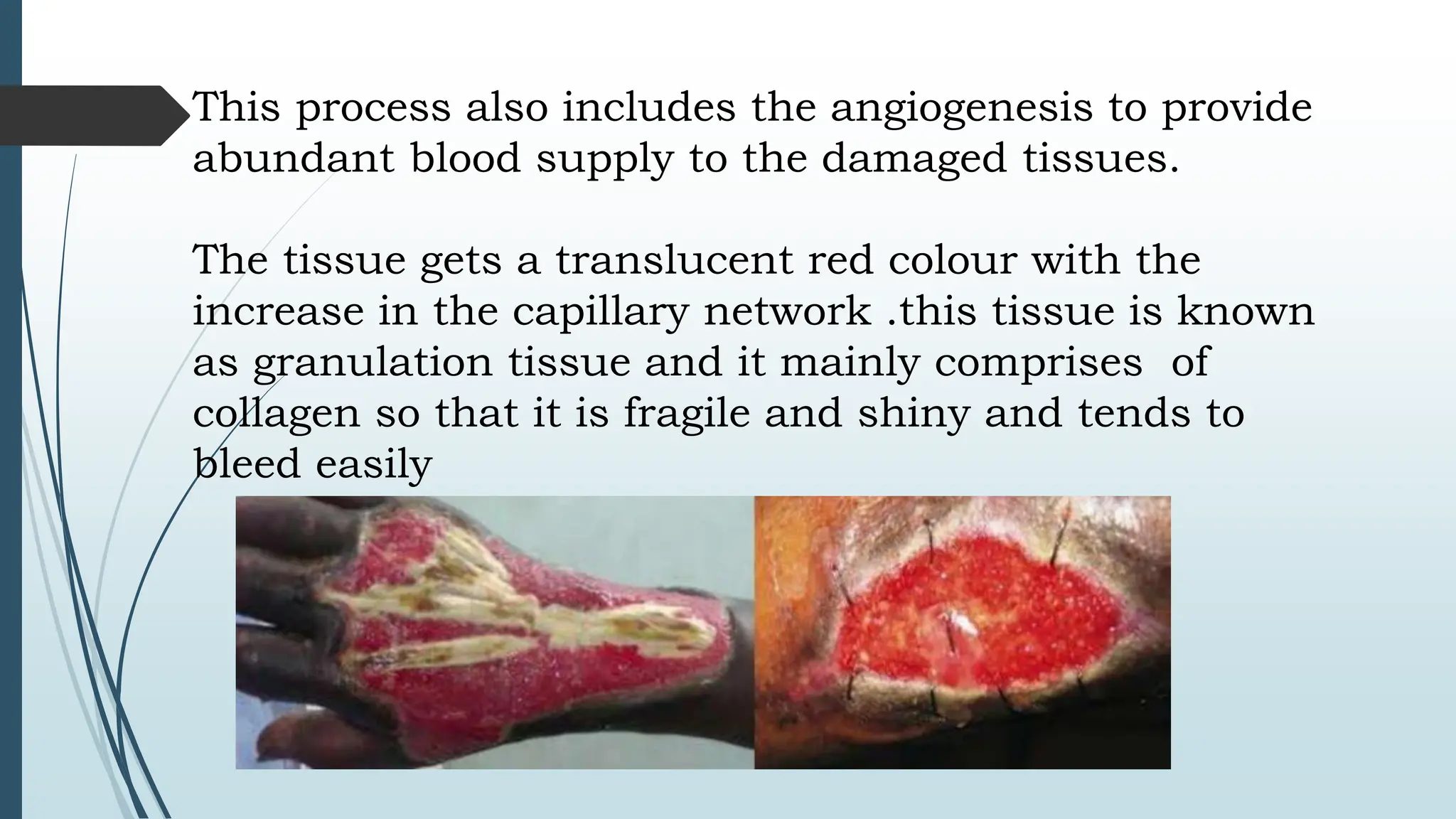 WOUND HEALING ....types of wound ..process of wound healing ...factors ...